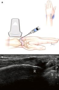 Ultrasound-Guided Hand, Wrist, and Elbow Injections - NYSORA