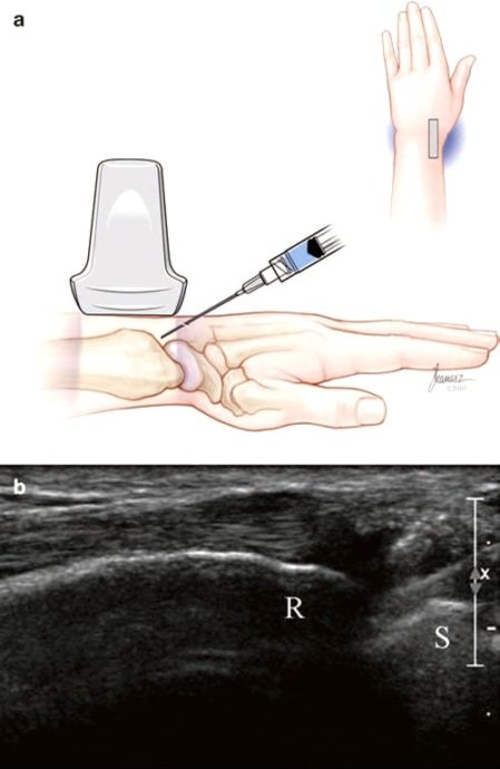 Ultrasound-Guided Hand, Wrist, and Elbow Injections - NYSORA