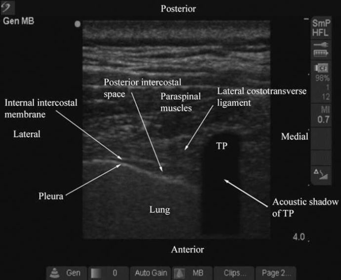 Ultrasound-Guided Thoracic Paravertebral Block - NYSORA