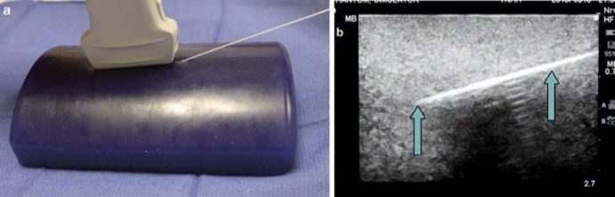 Ultrasound Technical Aspects: How to Improve Needle Visibility - NYSORA
