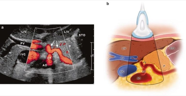 Bloc du plexus coeliaque et neurolyse guidés par ultrasons - NYSORA