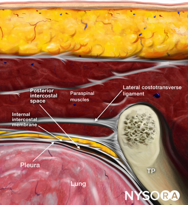 Ultrasound-Guided Thoracic Paravertebral Block - NYSORA
