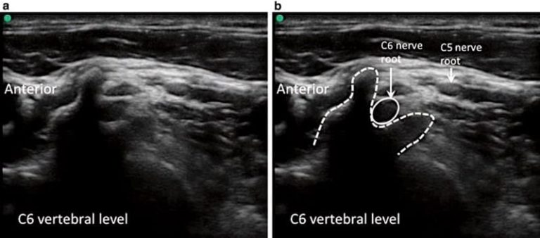 Ultrasound-Guided Upper Extremity Blocks - NYSORA