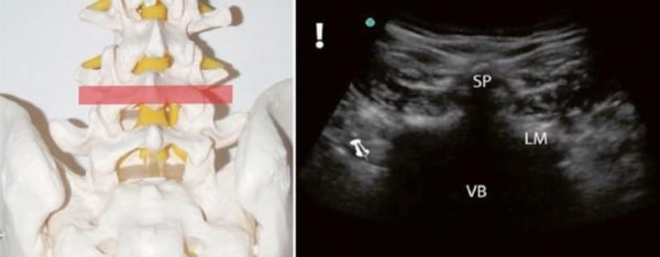 Ultrasound-Guided Lumbar Facet Nerve Block and Intra-articular ...