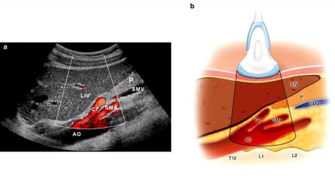 Bloc du plexus coeliaque et neurolyse guidés par ultrasons - NYSORA
