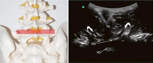Ultrasound-Guided Lumbar Facet Nerve Block and Intra-articular ...