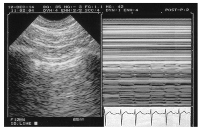 The A-Profile (Normal Lung Surface): 2) Lung Sliding - NYSORA