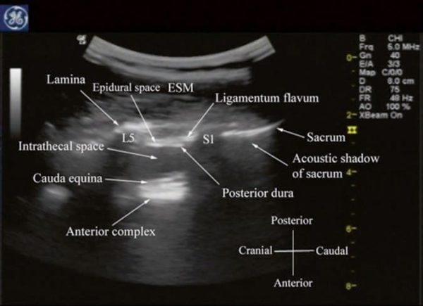 Ultrasound-Guided Central Neuraxial Blocks - NYSORA