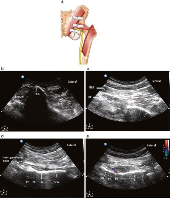 Ultrasound-Guided Blocks for Pelvic Pain - NYSORA