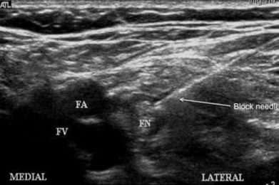 Ultrasound-Guided Nerve Blocks of the Lower Limb - NYSORA