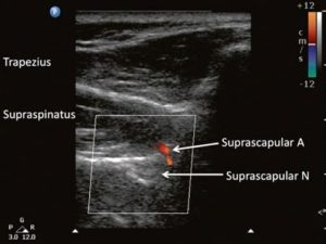 Bloqueo de nervio periférico guiado por ecografía en el tratamiento del ...