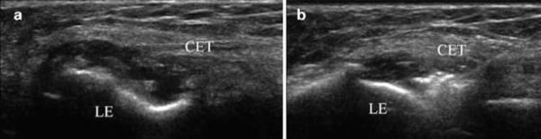 Ultrasound-Guided Hand, Wrist, and Elbow Injections - NYSORA