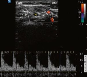 Ultrasound-Guided Cervical Nerve Root Block - NYSORA