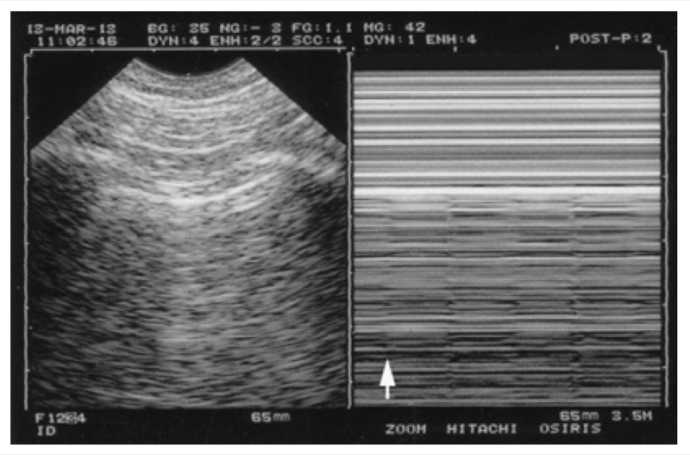 The A-Profile (Normal Lung Surface): 2) Lung Sliding - NYSORA