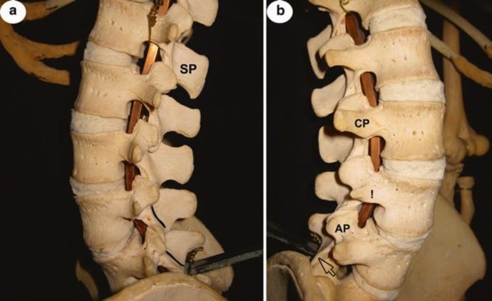 Spine Sonoanatomy for Pain Physicians - NYSORA