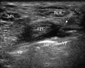 Ultrasound-Guided Hand, Wrist, and Elbow Injections - NYSORA