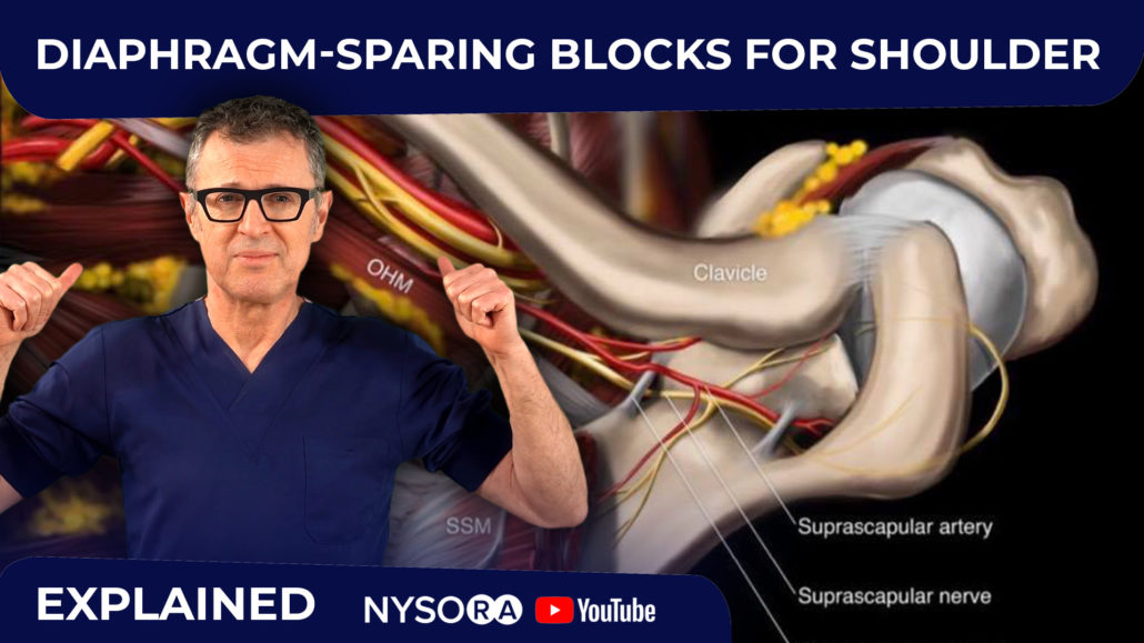 Diaphragm-sparing nerve blocks for analgesia after shoulder surgery ...