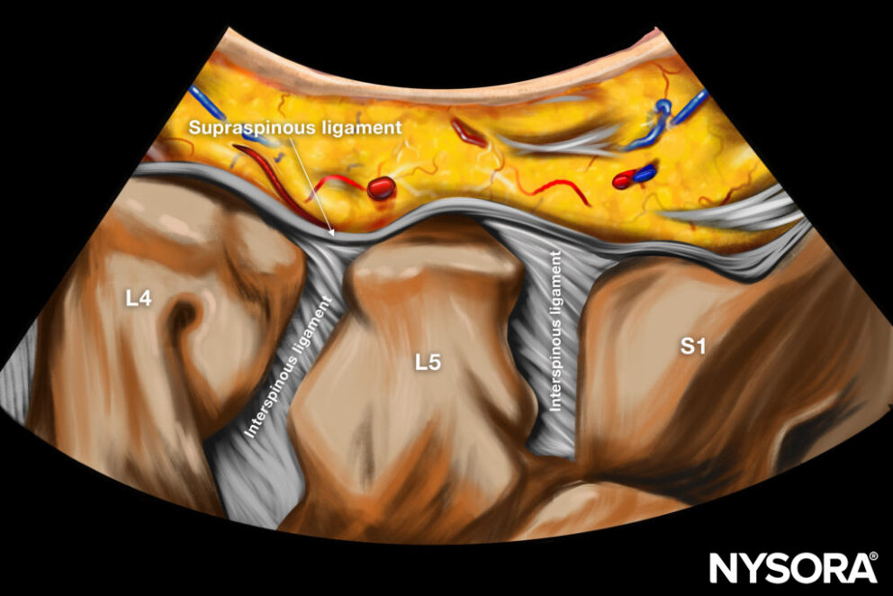 Ultrasound-Guided Lumbar Nerve Root (Periradicular) Injections - NYSORA