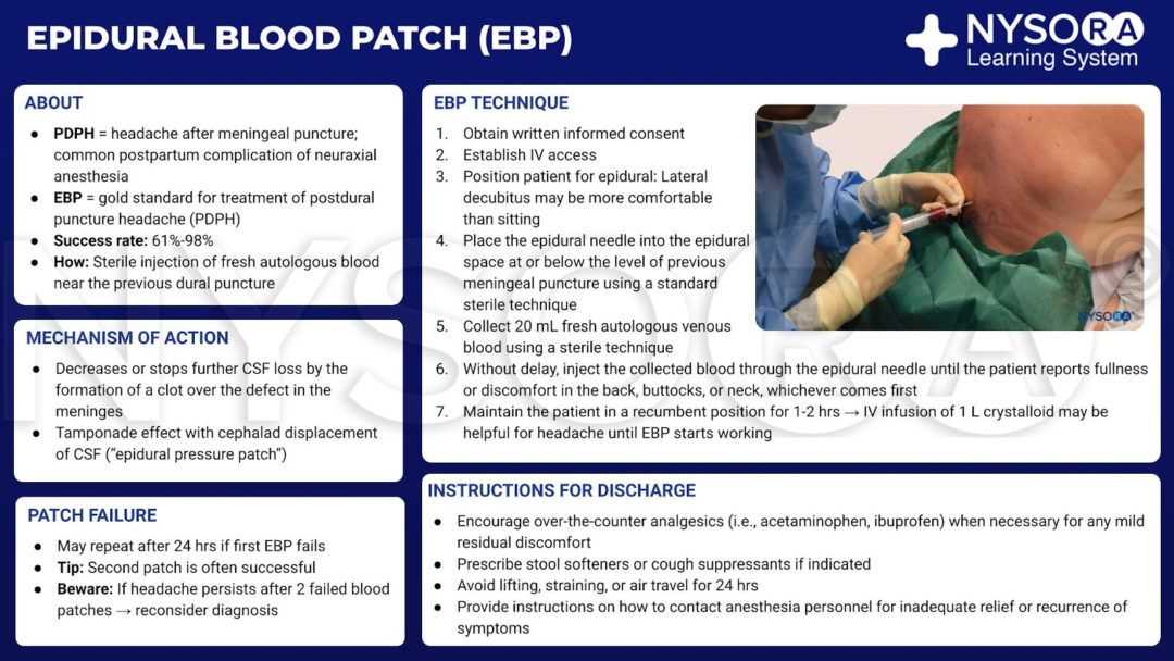 Patch de sangue epidural: como fazer - NYSORA