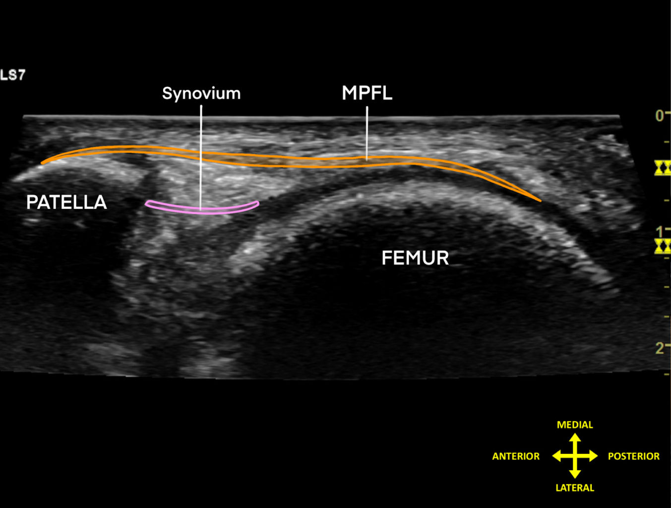 Astuce MSK de la semaine pour scanner le ligament fémoro-patellaire ...