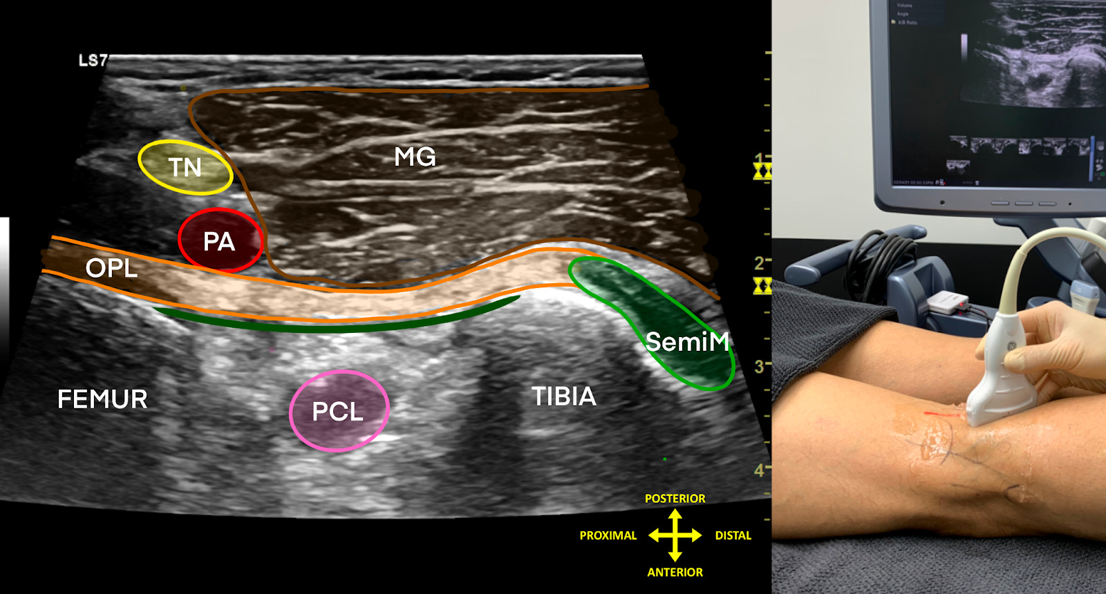 Sugerencia de la semana de MSK para escanear el ligamento poplíteo oblicuo
