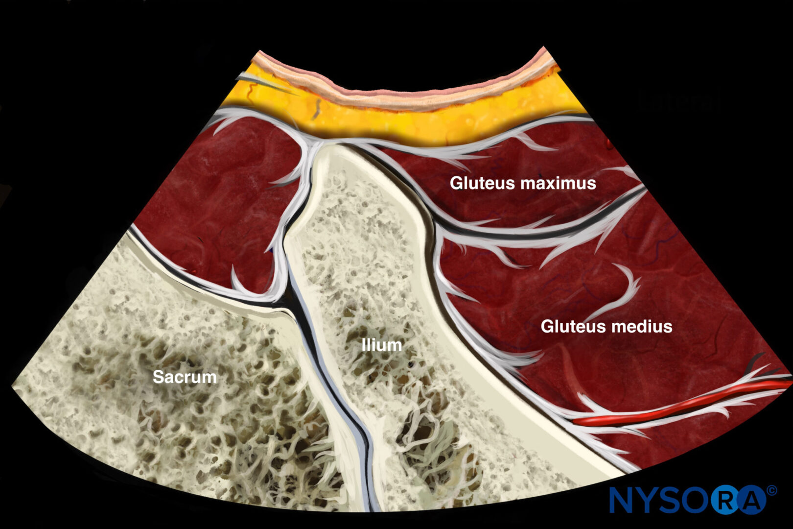 Ultrasound Pain Block Tip of the Week: Piriformis Muscle Injection - NYSORA