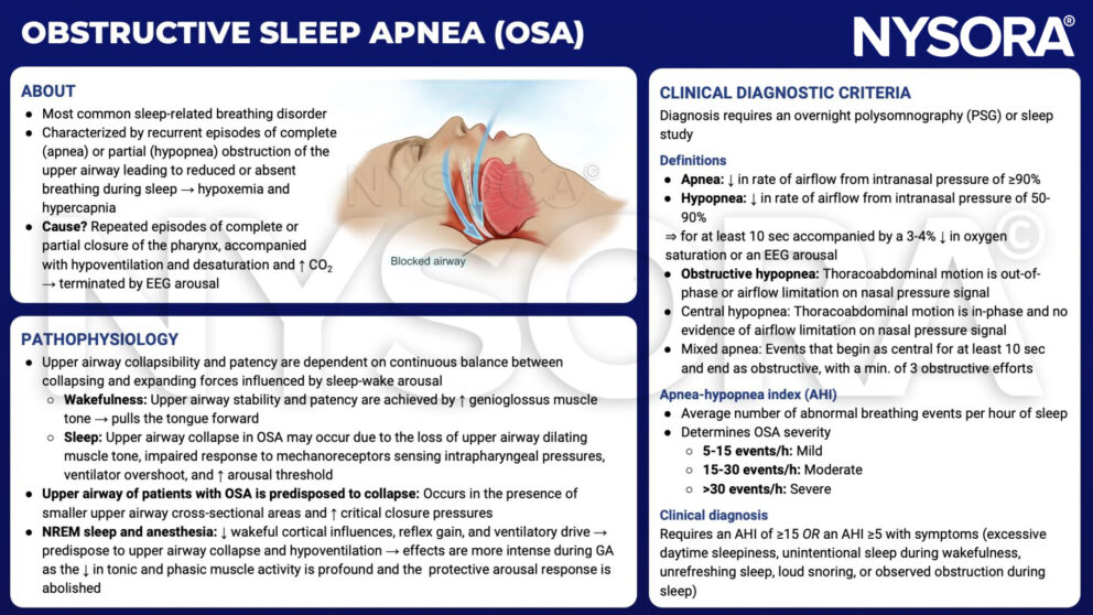 Obstructive sleep apnea - NYSORA