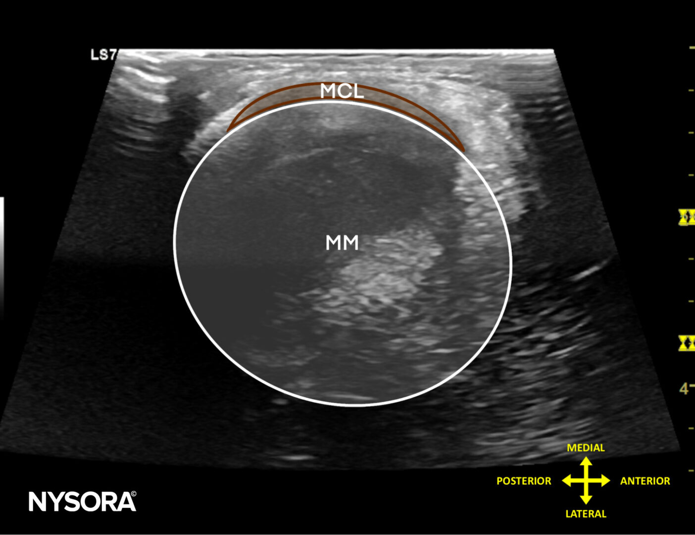 MSK Tip of the Week for Scanning the Medical Meniscus in a Transverse ...