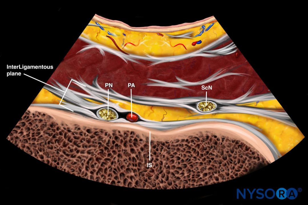 Ultrasound Pain Block Tip of the Week: Pudendal Nerve Block - NYSORA