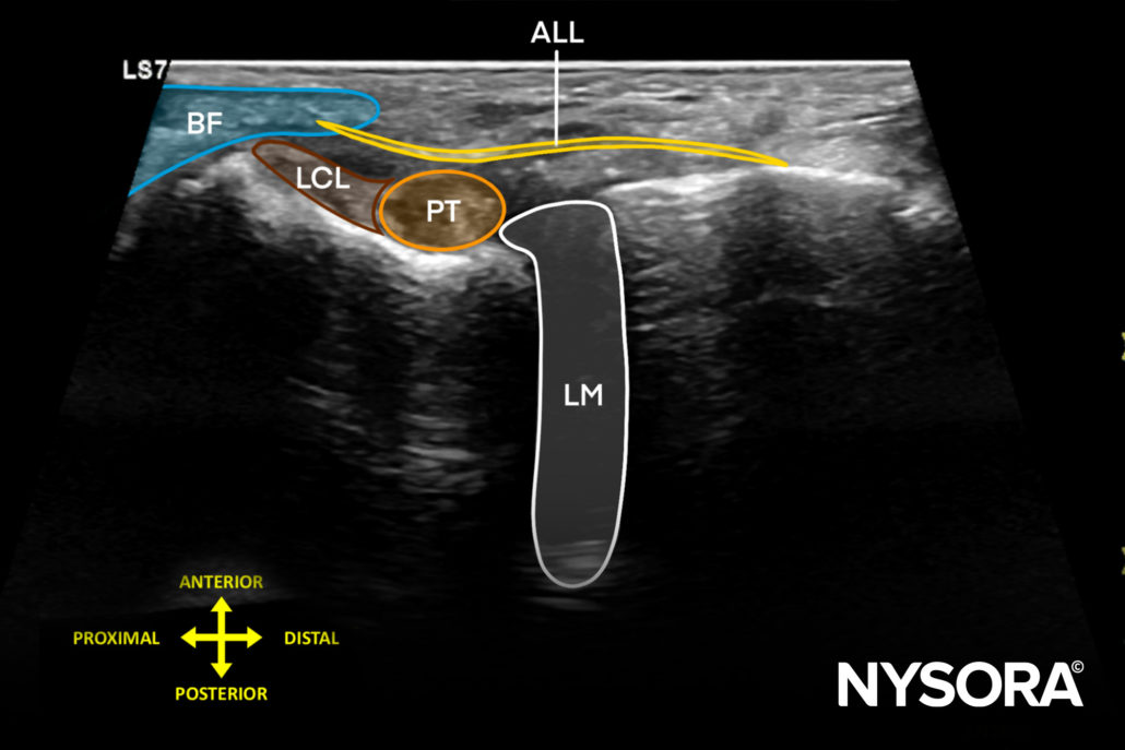 MSK Tip of the Week for Scanning the Lateral Meniscus in a Longitudinal ...