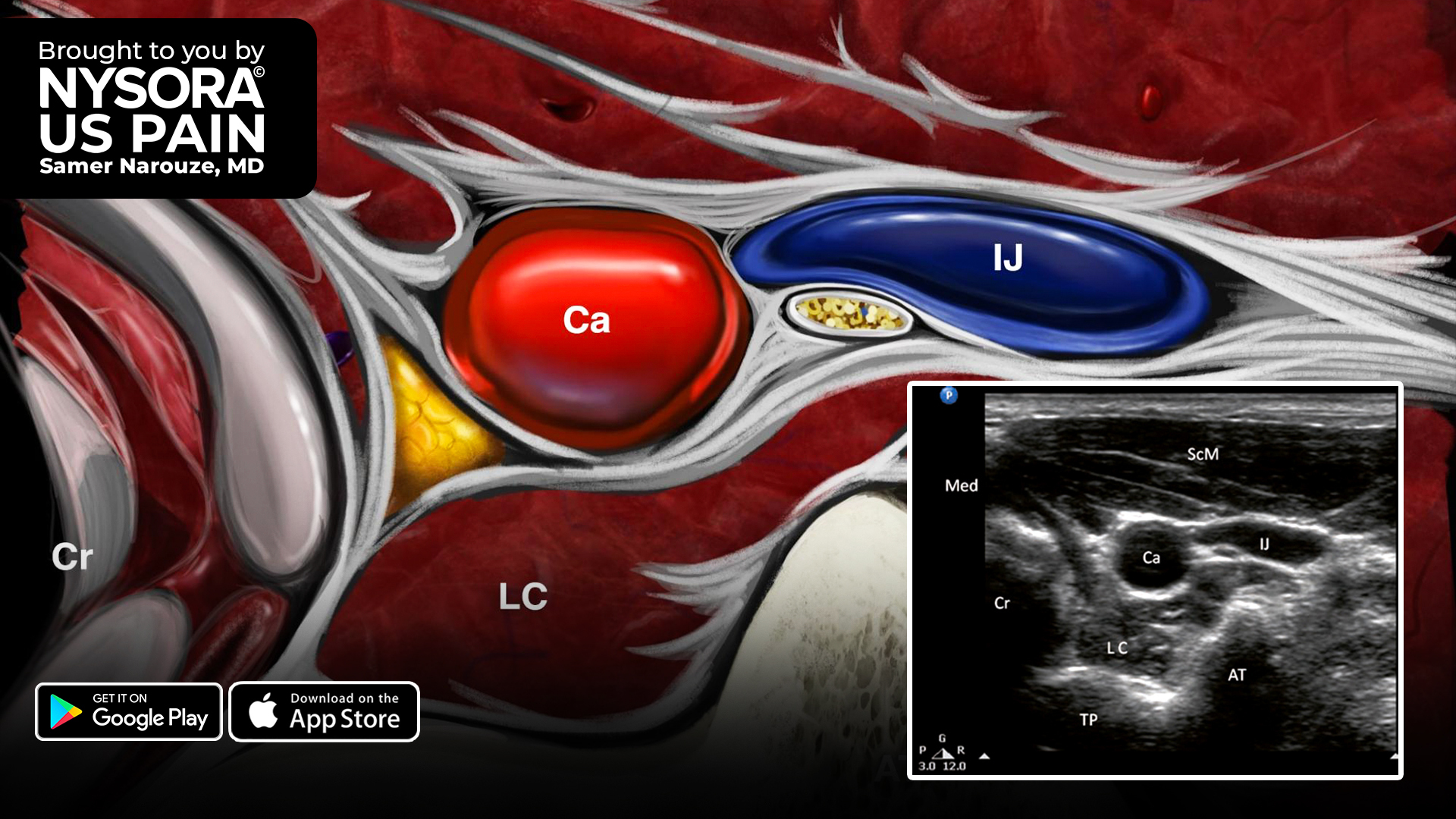 Tips for a Cervical Sympathetic Block - NYSORA