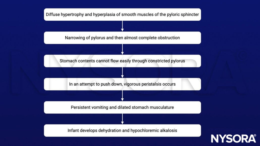 Pyloric stenosis - NYSORA