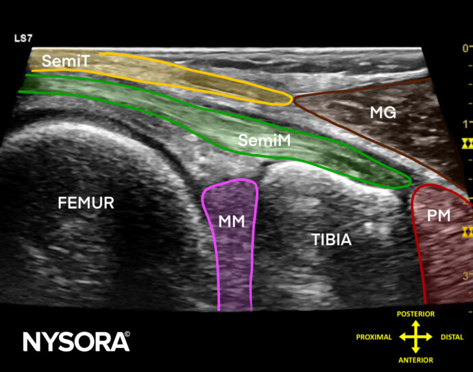 Tips for scanning Baker’s Cyst in a longitudinal orientation - NYSORA
