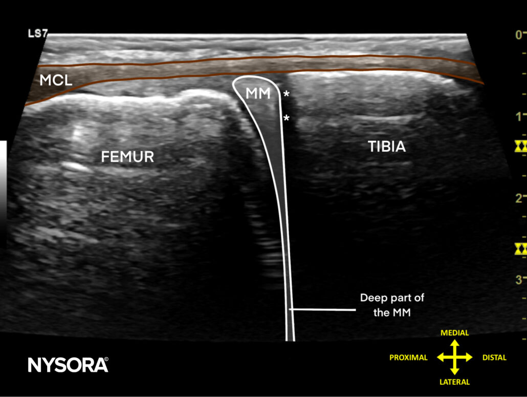 Tips for scanning the medial meniscus in a longitudinal orientation ...