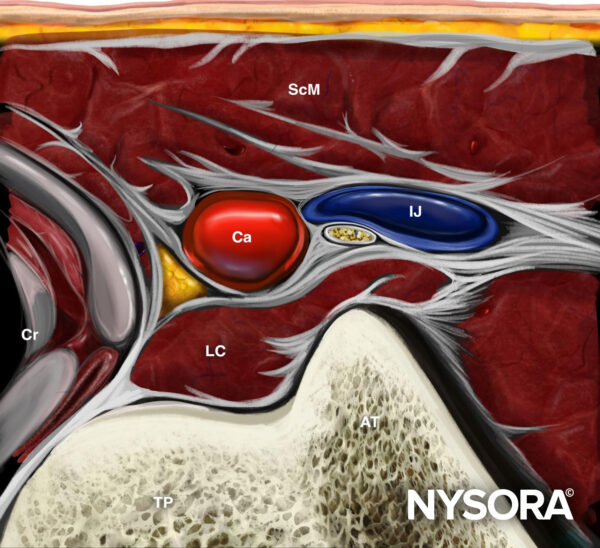 Tips for a Cervical Sympathetic Block - NYSORA