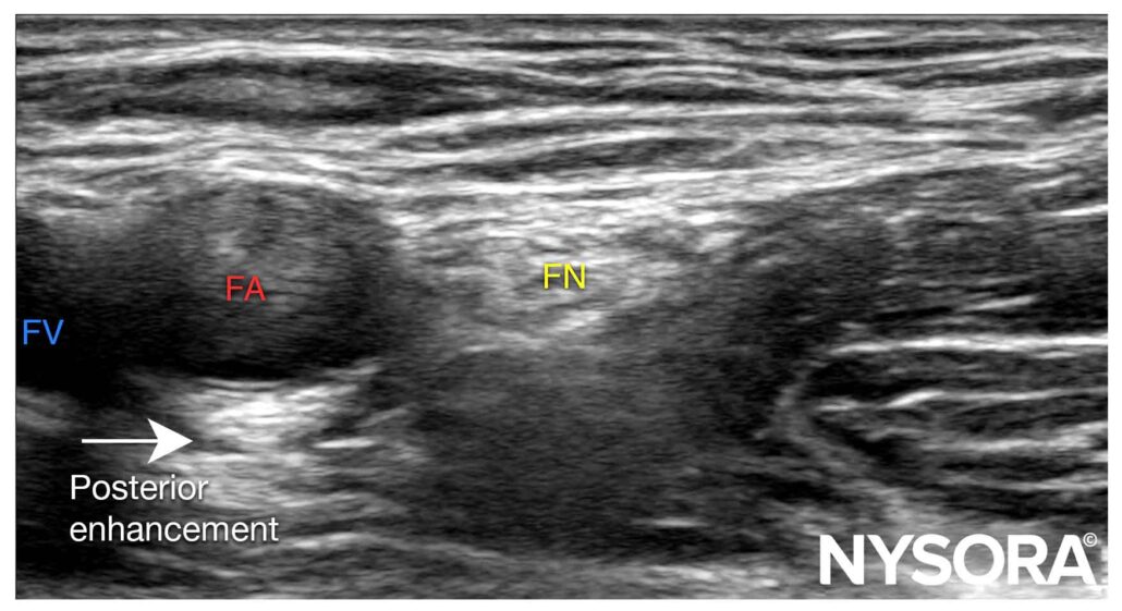 Ultrasound image artifacts explained - NYSORA