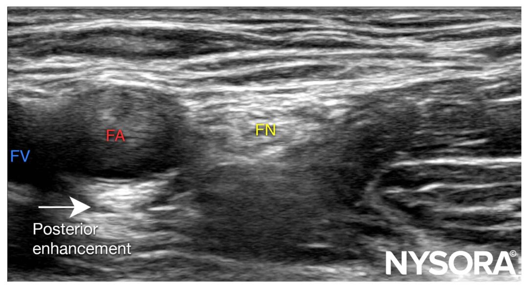 Ultrasound image artifacts explained - NYSORA