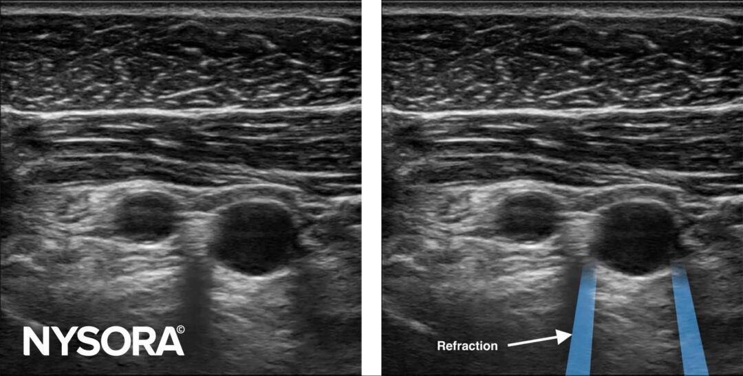 Ultrasound image artifacts explained - NYSORA
