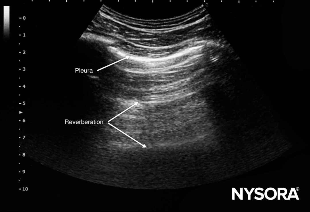 Ultrasound image artifacts explained - NYSORA