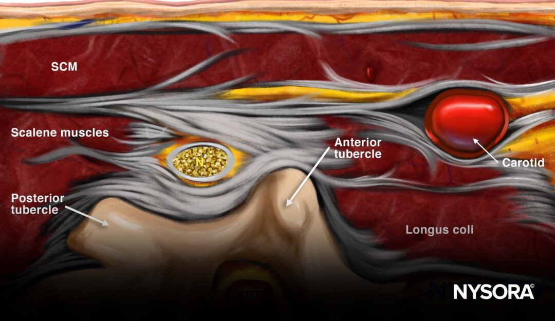 3 Fig 6 Techniquecervical Nerve Root Block1 2 1 Nysora Nysora