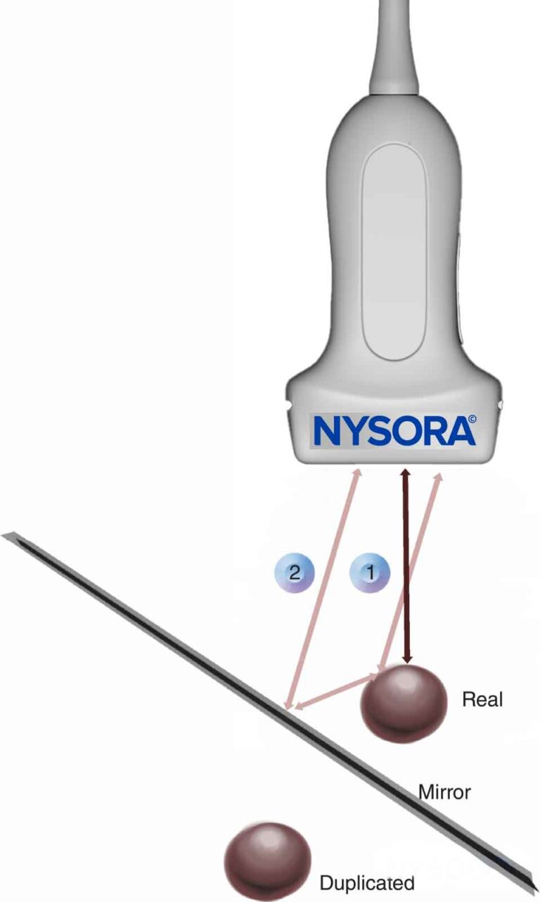 Ultrasound image artifacts explained - NYSORA