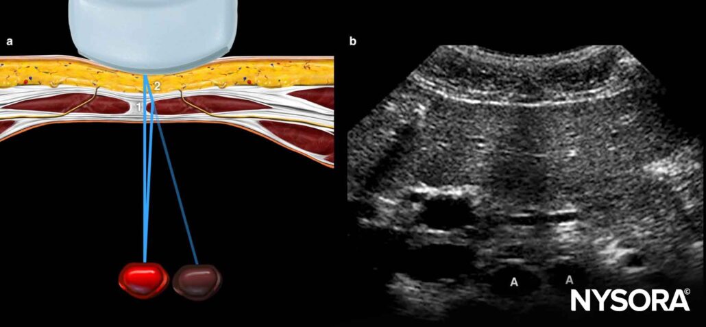 Ultrasound image artifacts explained - NYSORA