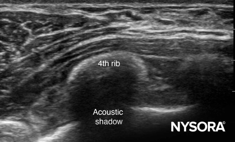 Ultrasound image artifacts explained - NYSORA