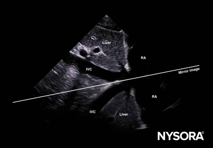 Ultrasound image artifacts explained - NYSORA