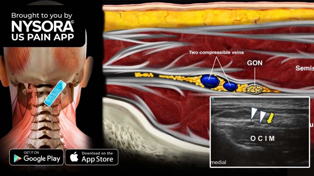 Occipital Nerve Block Needle