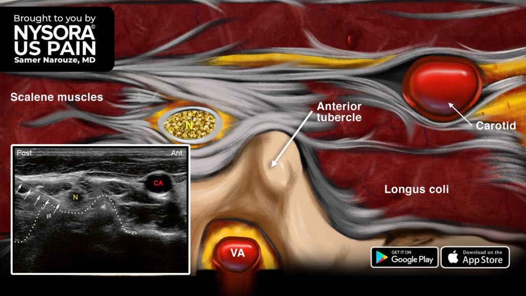 Tips for the Cervical Nerve Root Block - NYSORA
