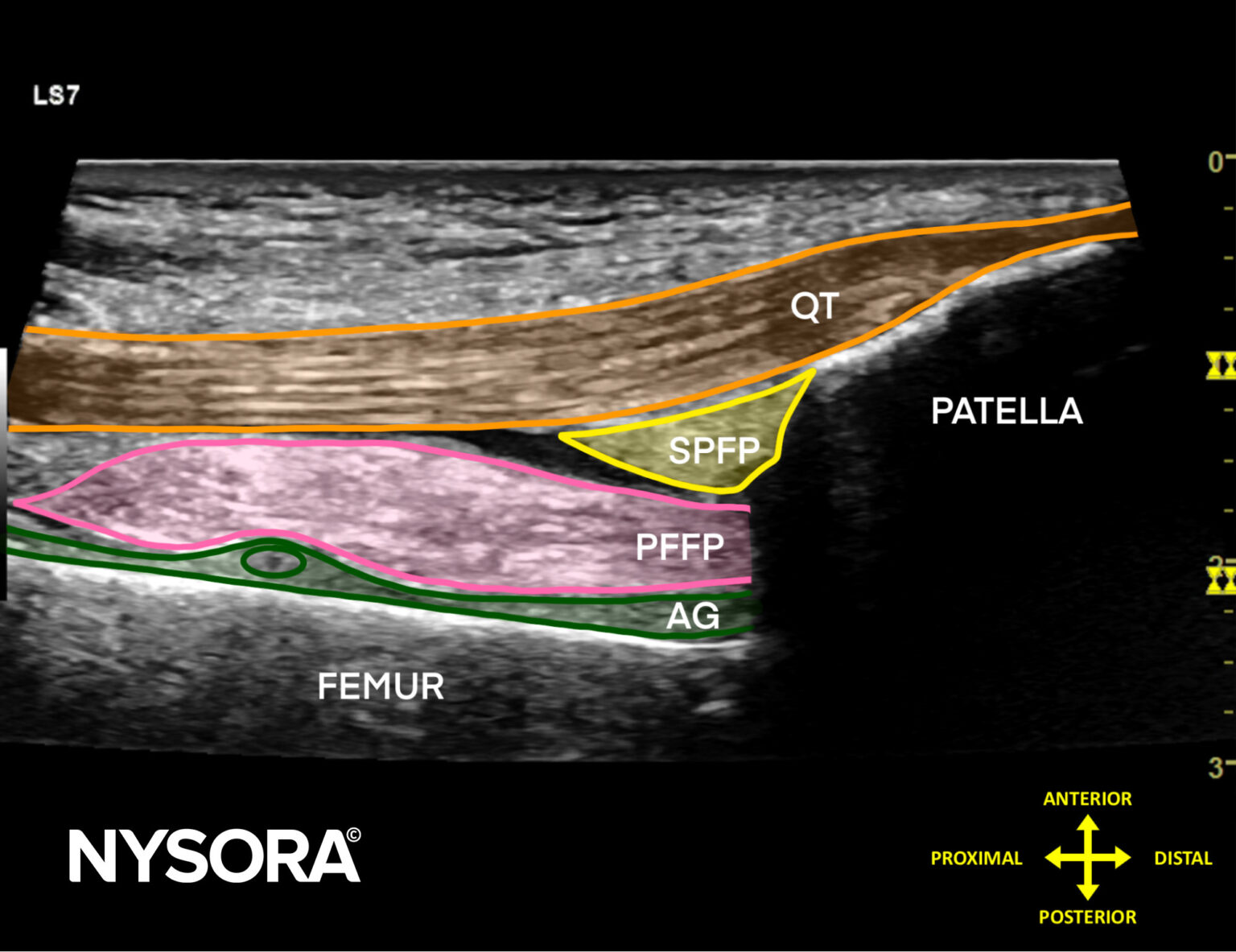 Tips for scanning the quadriceps tendon in a longitudinal orientation ...