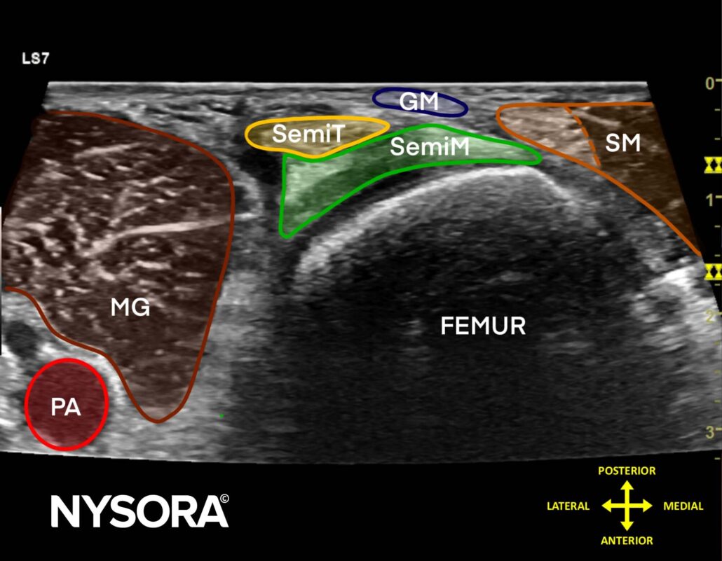 Tips for scanning Baker’s cyst in a transverse orientation - NYSORA