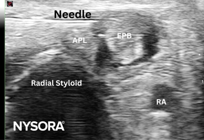 Patient Case Study: De Quervain’s Tenosynovitis - Injection - NYSORA