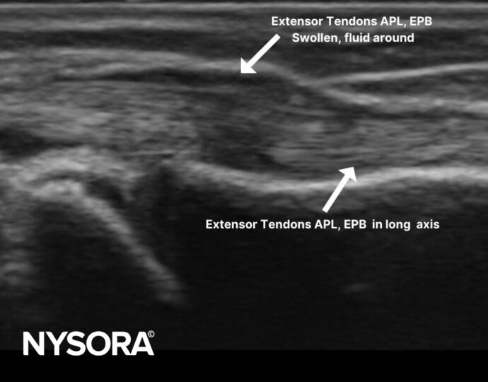 Patient Case Study: De Quervain’s Tenosynovitis - Injection - NYSORA